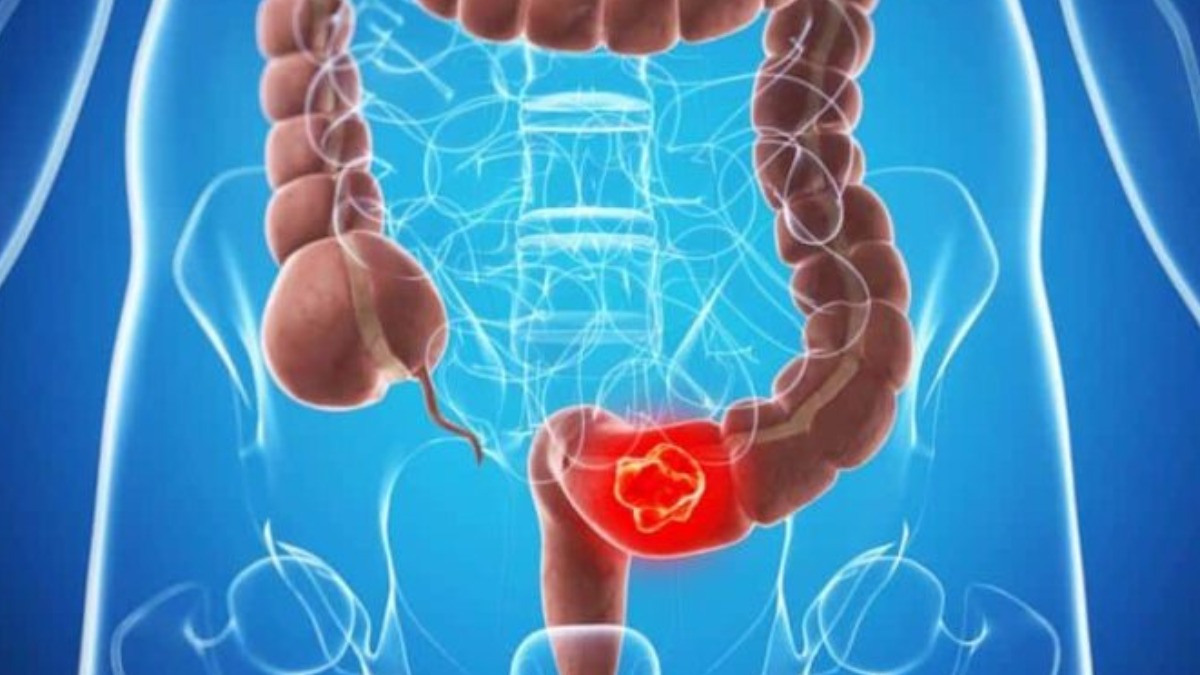 Taxa de incidência no número de casos de câncer de cólon e reto deve ...