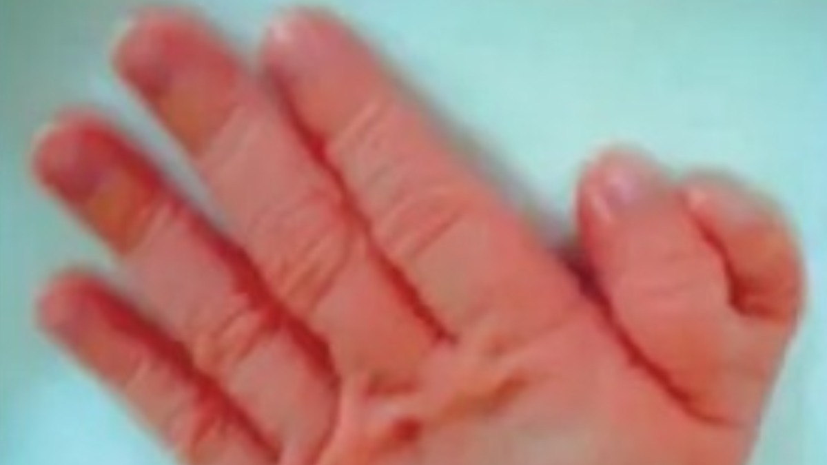 Você já ouviu falar em Polidactilia? Saiba mais sobre essa condição ...