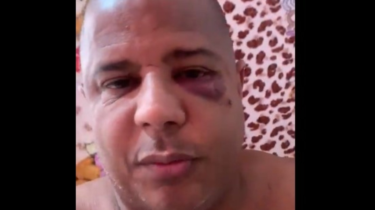 Com olho roxo, Marcelinho revela causa de sumiço; assista - tudoep